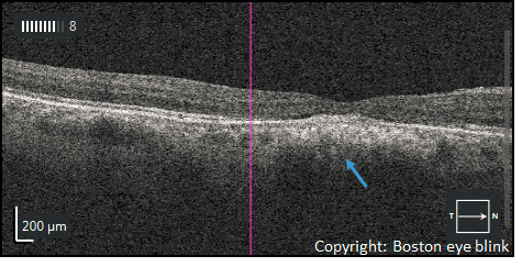Freckle in the wrong place – Boston Eye Blink
