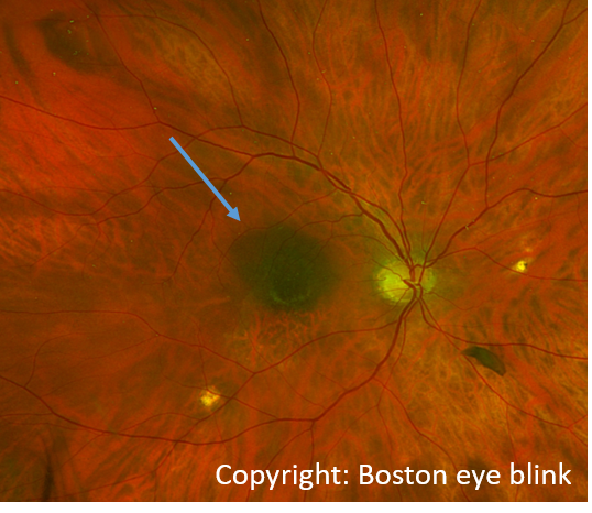 Freckle in the wrong place – Boston Eye Blink